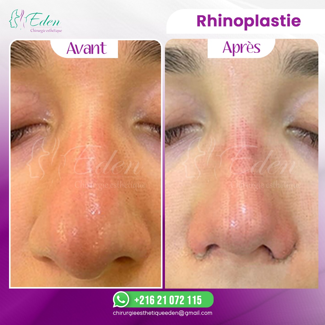 Rhinoplastie Tunisie prix pas cher - Eden Chirurgie Esthétique